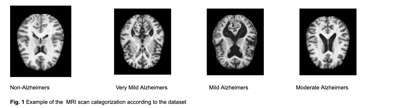 Alzhiemer's MRI Classification Project